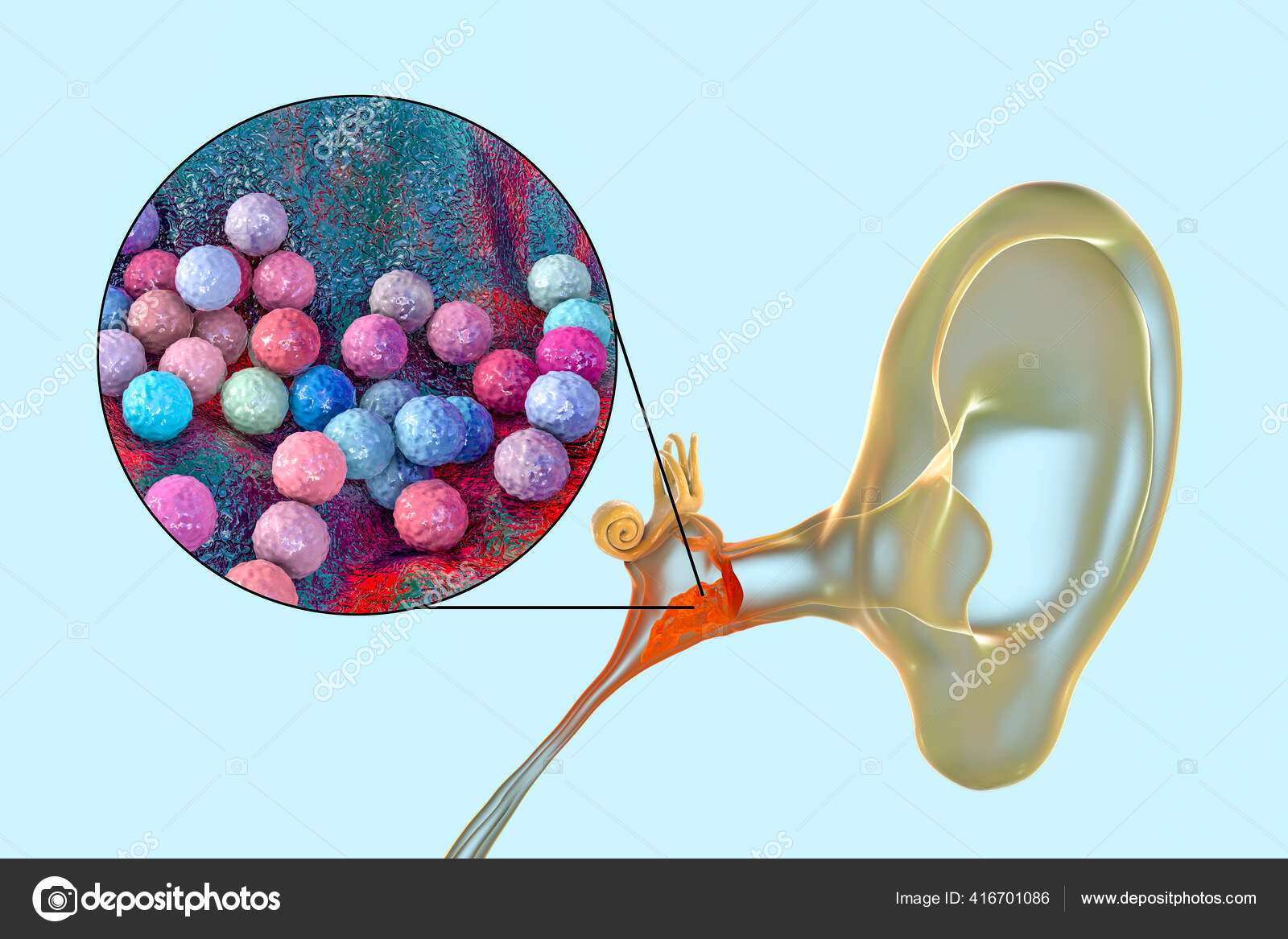 Otitis Media Caused Bacteria Staphylococcus Aureus Inflammatory Disease ...