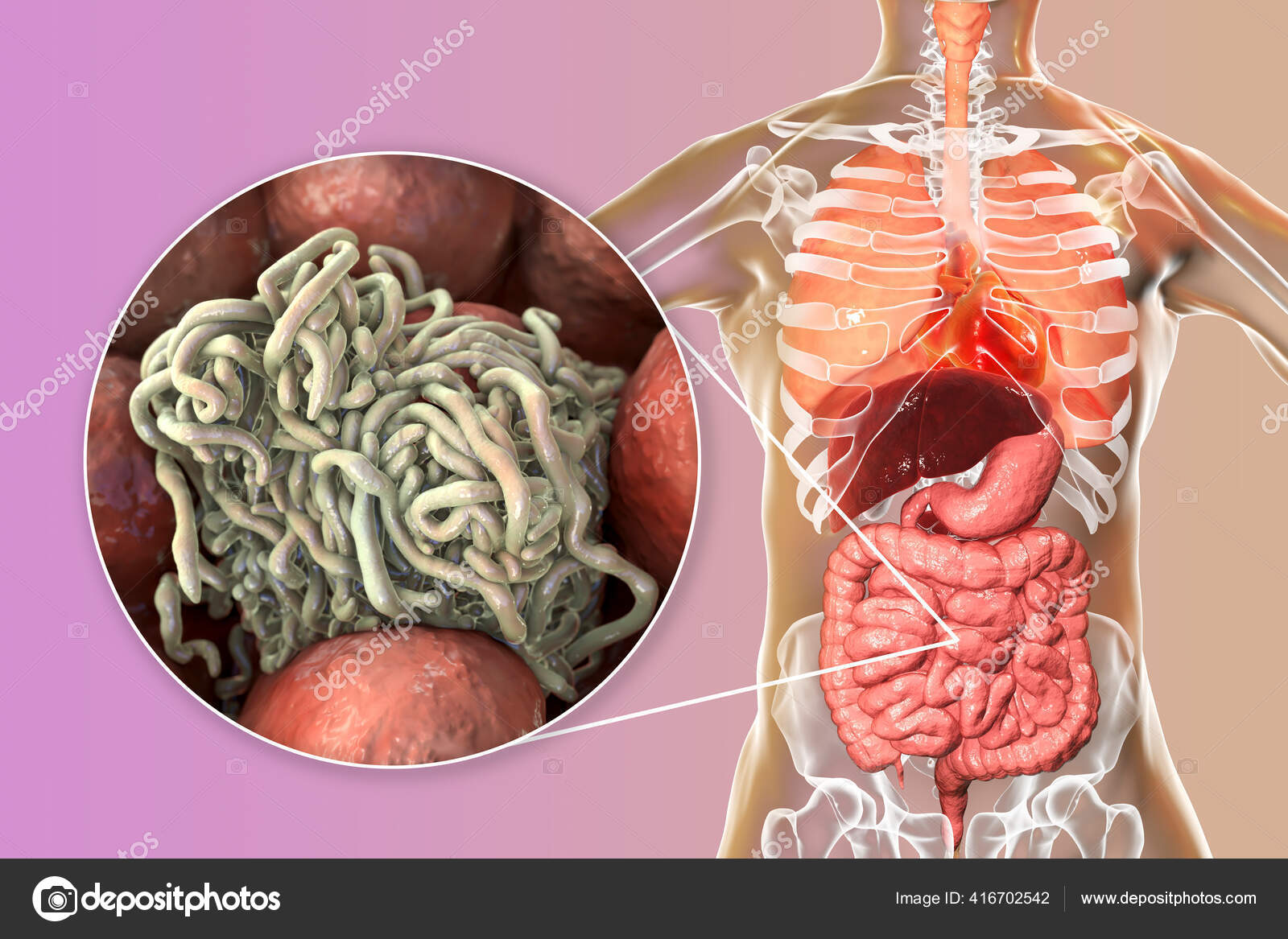 Roundworms In Humans