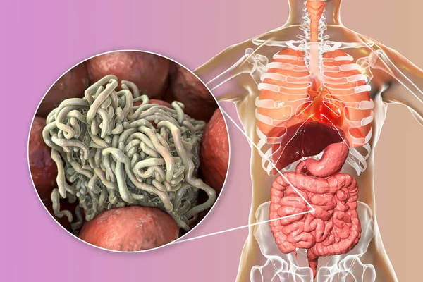 Vermes Parasitas Intestino Delgado Humano Ilustração Ascaris ...