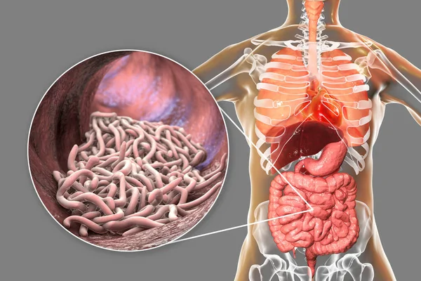 Parasitic Worms Human Intestine Illustration Ascaris Lumbricoides Other ...