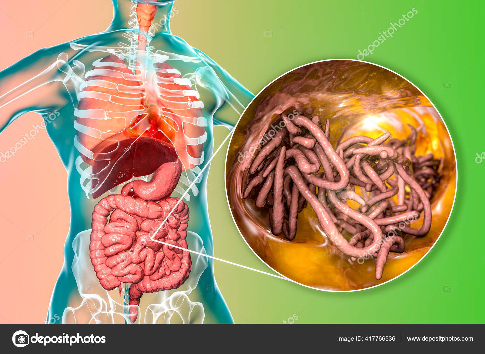 Pinworms In Human Stool