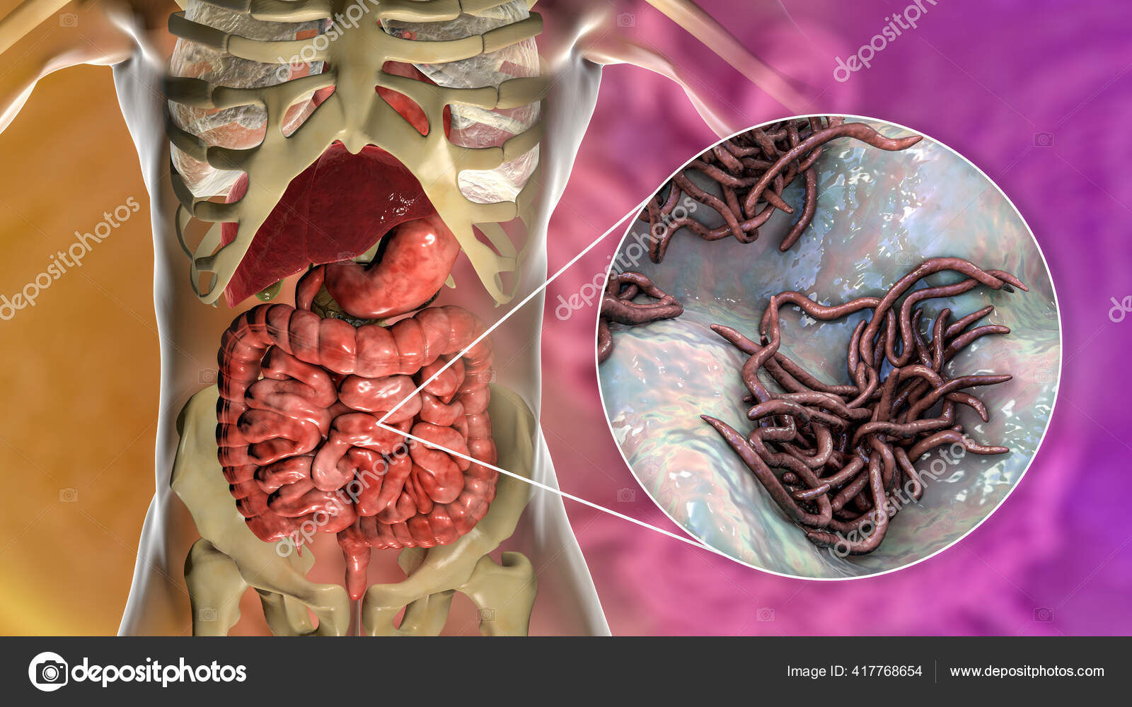 Gusanos Parásitos Intestino Delgado Humano Ilustración Ascaris ...