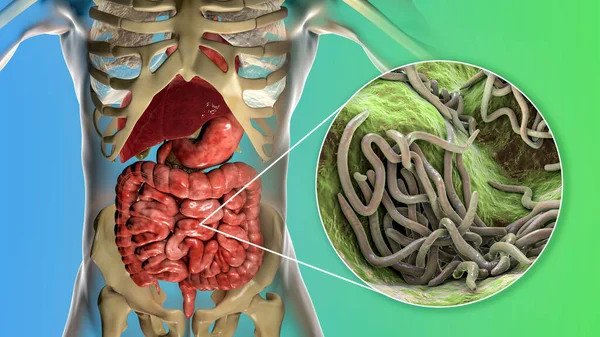 Pinworm In Human Stool