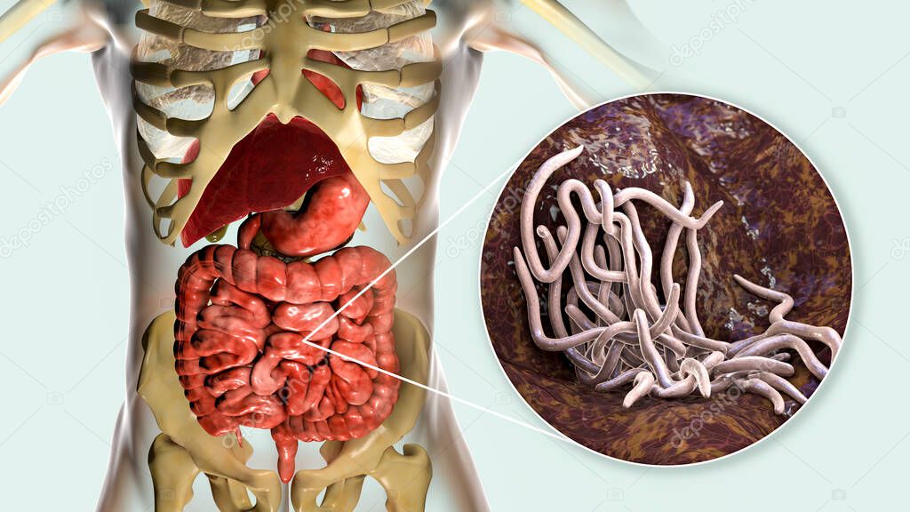 Gusanos parásitos en el intestino delgado humano, ilustración 3D ...
