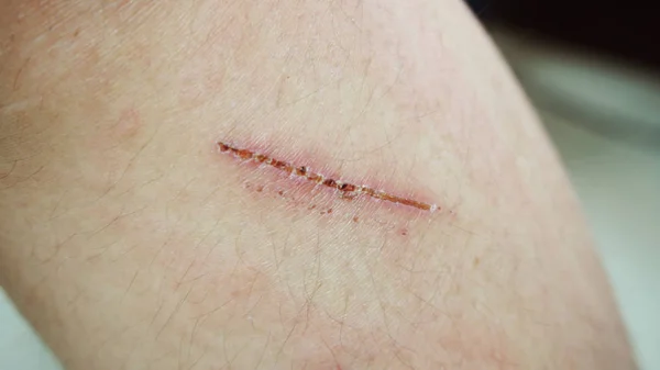 Cuts and abrasion Stock Photos, Royalty Free Cuts and abrasion Images ...