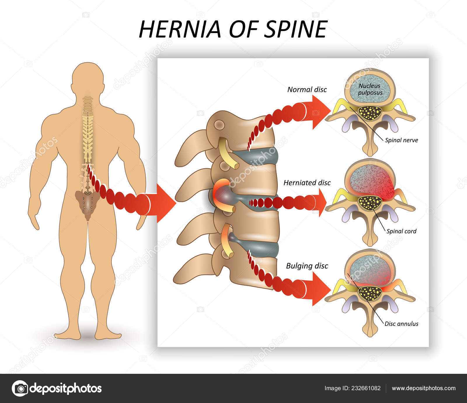 Anatomy Medical Diagram Human Spine Hernia Description All Sections