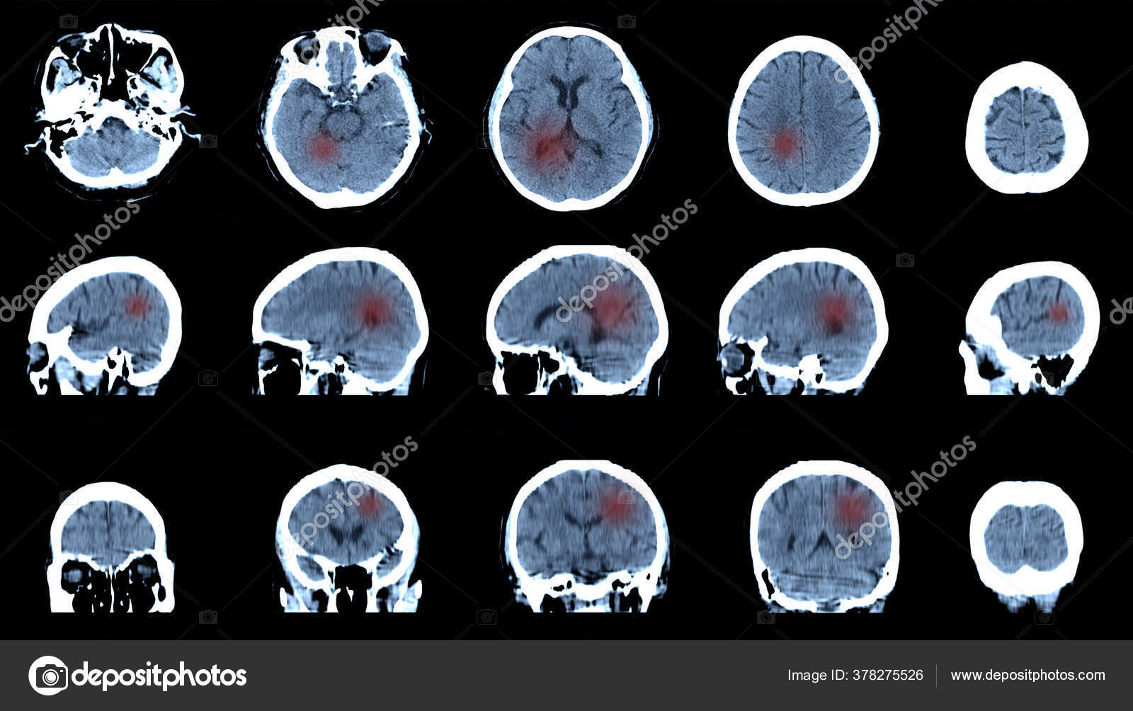 Mri Scan Otak Pindai Otak Sagital Coronal Transverse Image Untuk ...