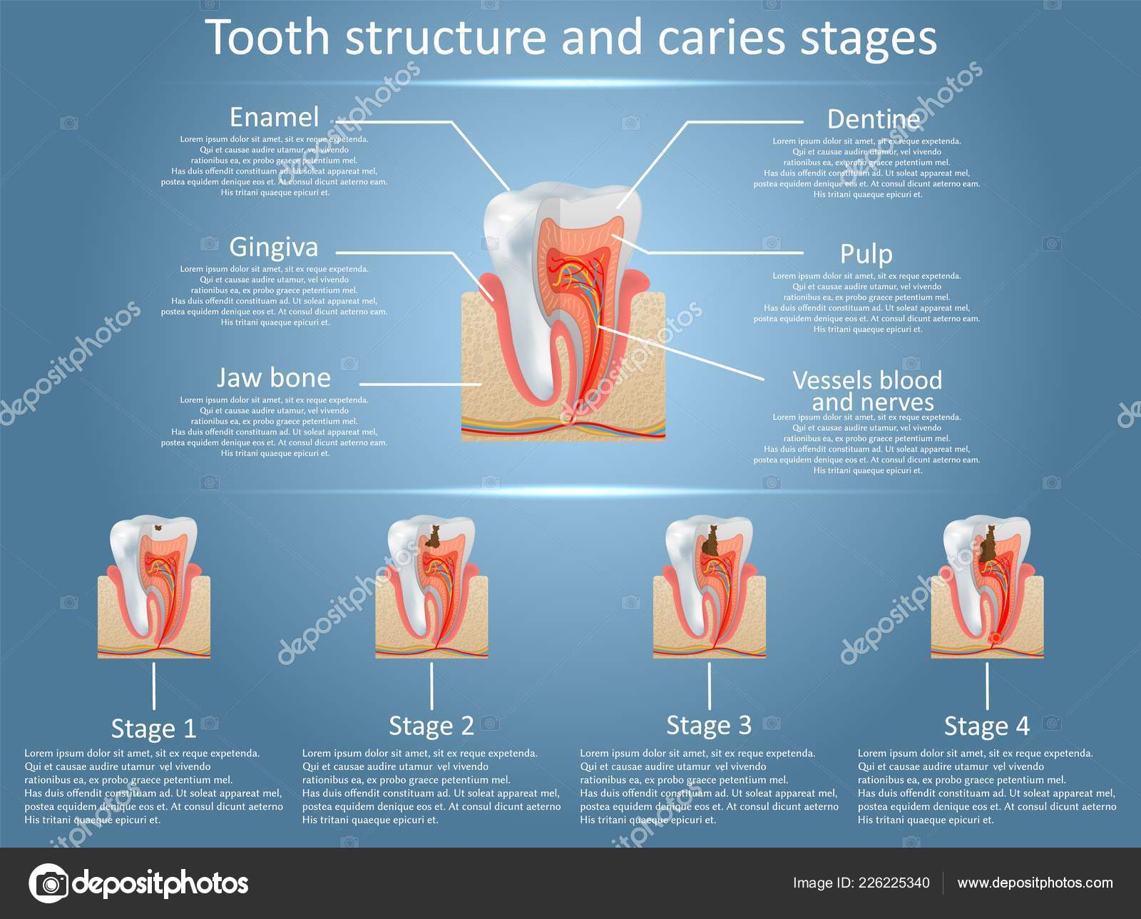 Diagram Vektor Struktur Gigi Manusia Dan Tahapan Karies Anatomi Gigi ...