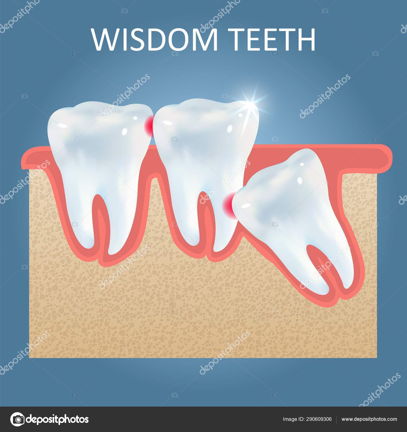 Wisdom teeth problems vector poster design template Stock Vector Image ...