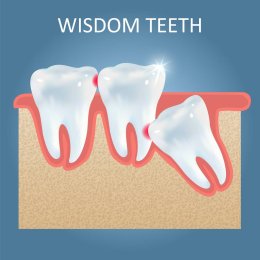 Wisdom teeth Stock Photos, Royalty Free Wisdom teeth Images | Depositphotos