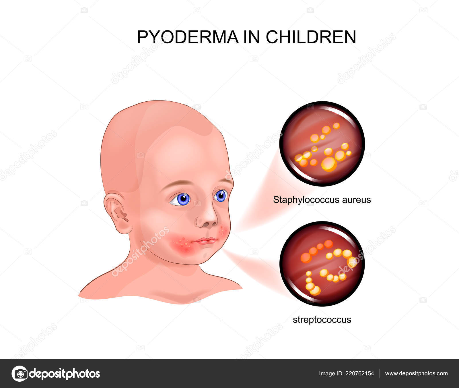 Ilustración Vectorial Pioderma Infantil Estreptococo Estafilococo ...