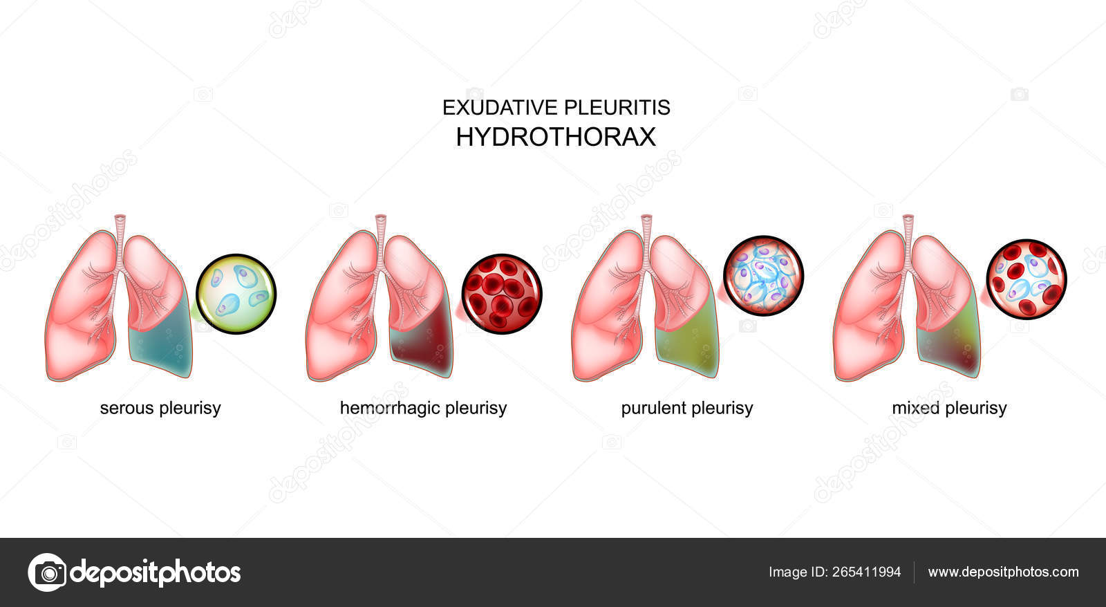 Tipos de pleuresía exudativa e hidrotórax vector, gráfico vectorial ...