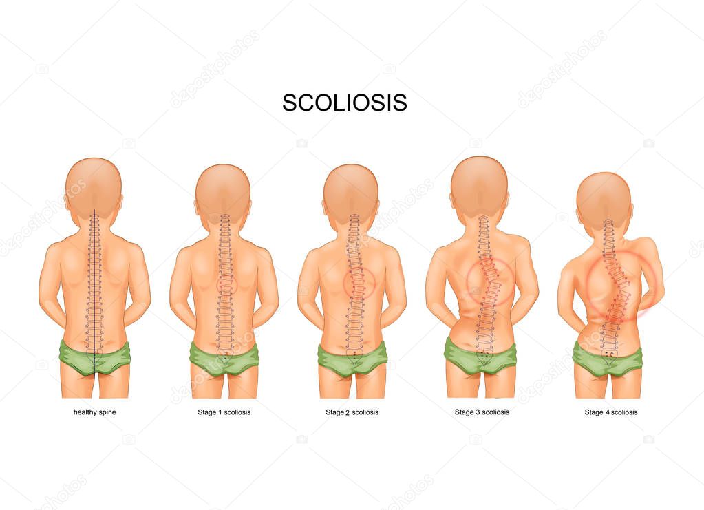 escoliosis en niños 2024