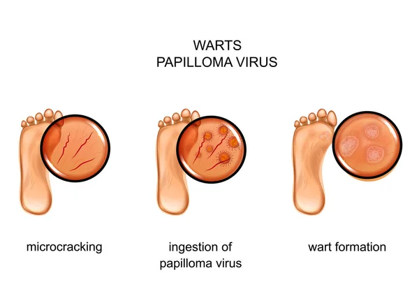 329 Warts Vector Images, Warts Illustrations | Depositphotos