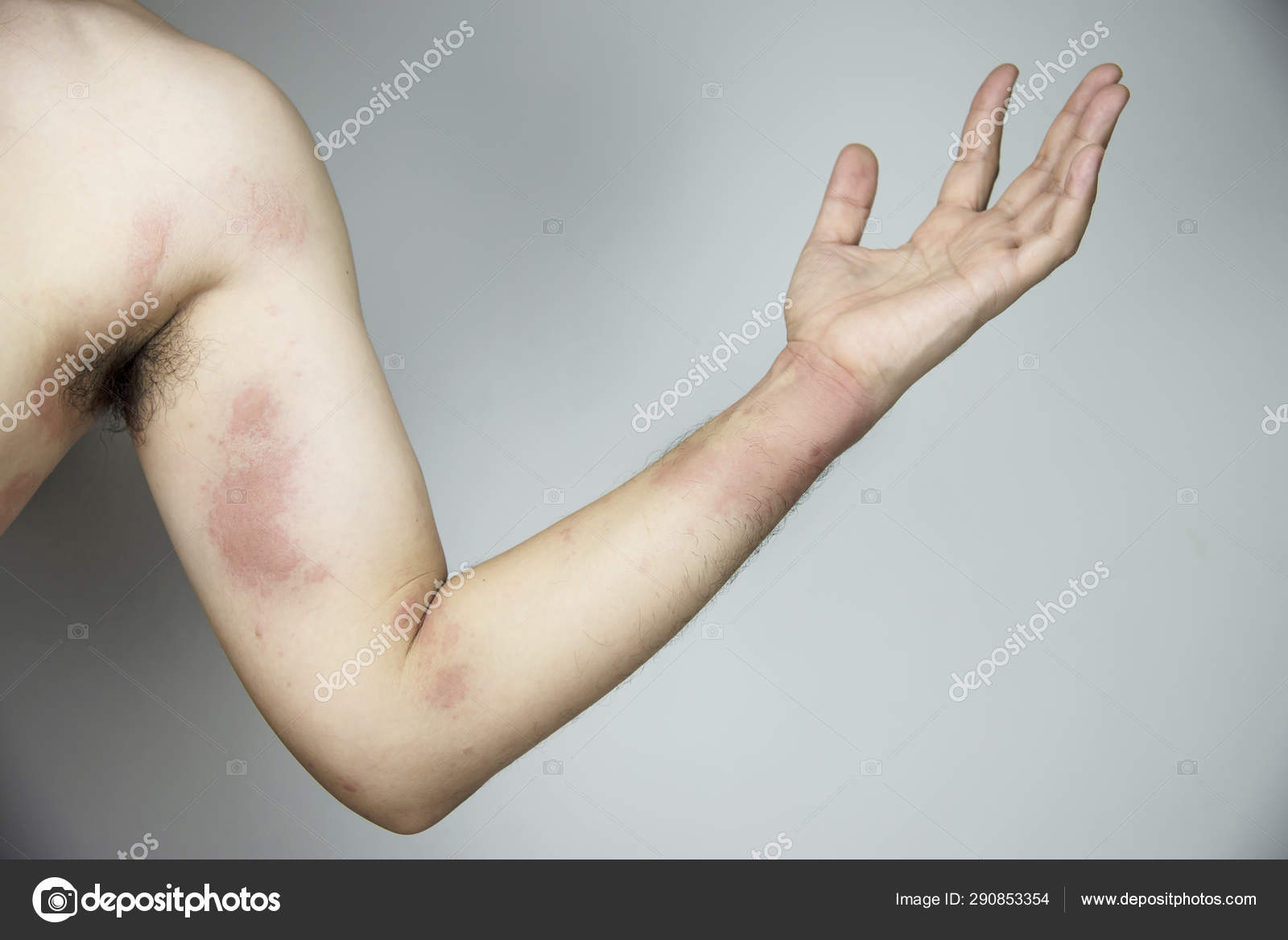 Hombre Con Sarpullido Piel Roja Parte Del Cuerpo Personas Con — Foto de ...