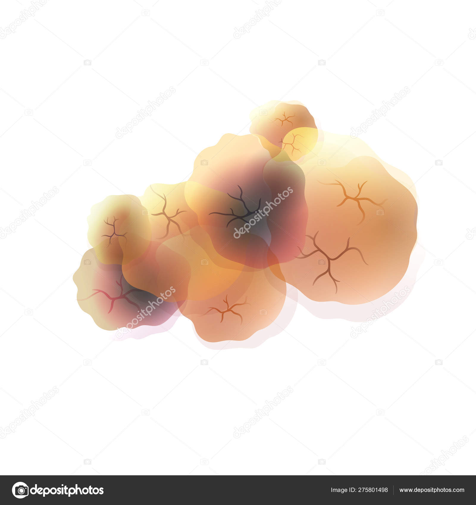Vector isolated illustration of tumor Stock Vector Image by ©Pikovit ...