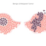 Vector isolated illustration of malignant tumor Stock Vector Image by ...