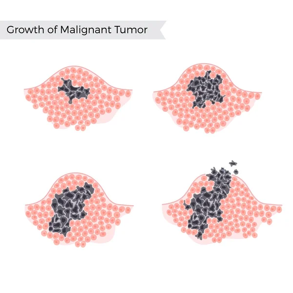 Vector isolated illustration of malignant tumor Stock Vector Image by ...