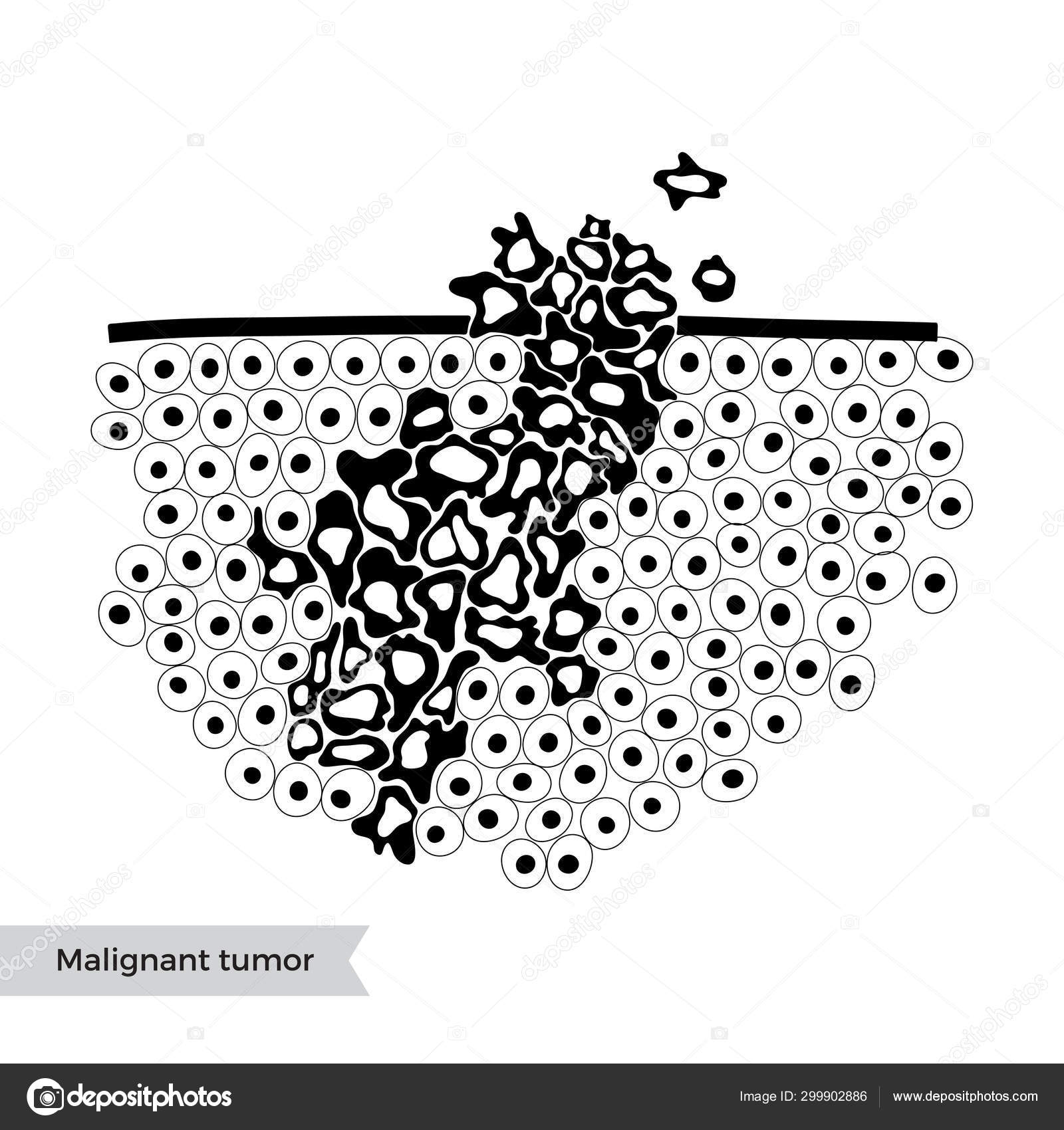 Vector isolated illustration of malignant tumor Stock Vector Image by ...