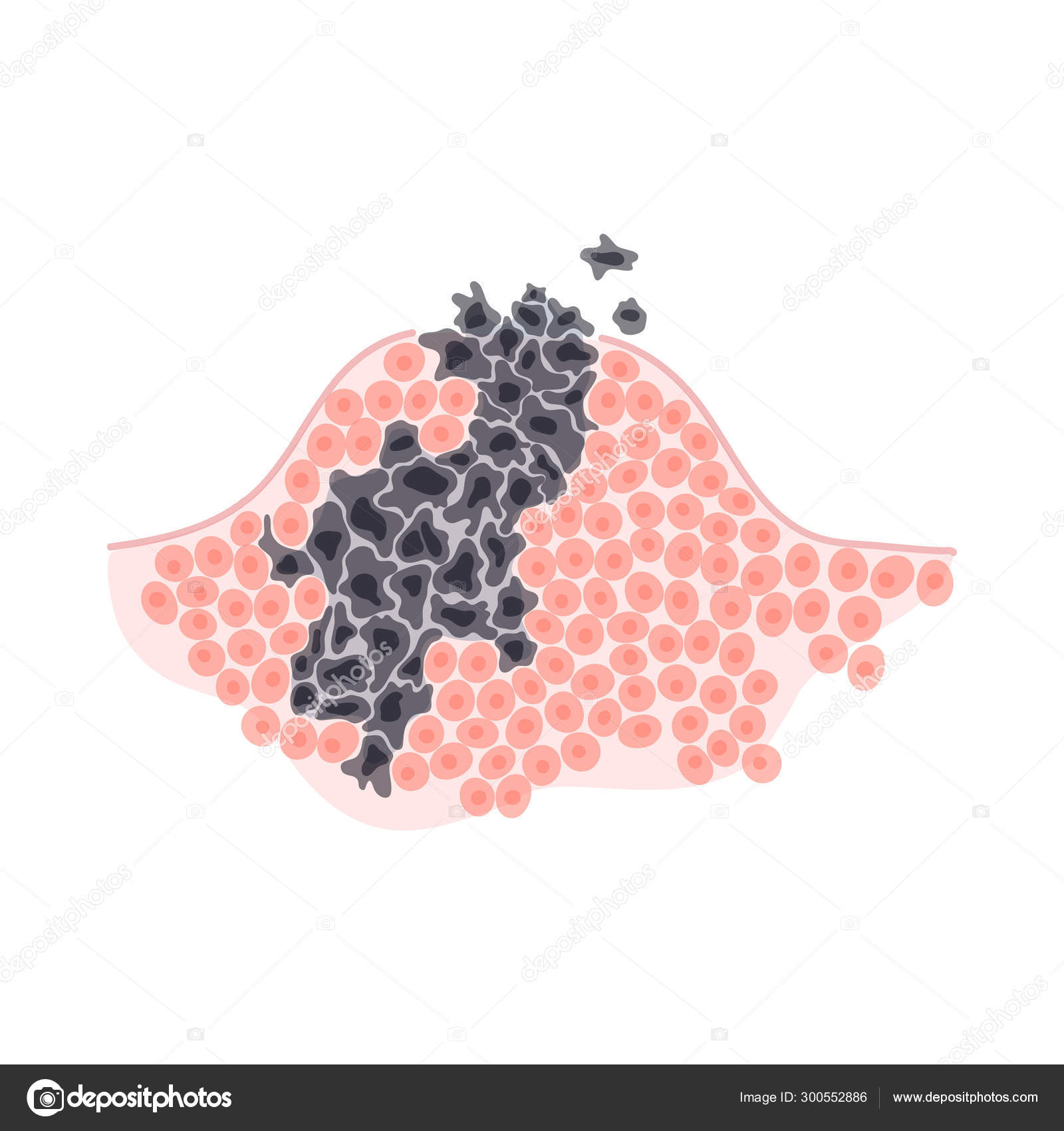Vector isolated illustration of malignant tumor Stock Vector Image by ...