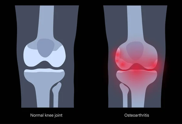 Arthritis in knee joint Stock Vector Image by ©Pikovit #415061542