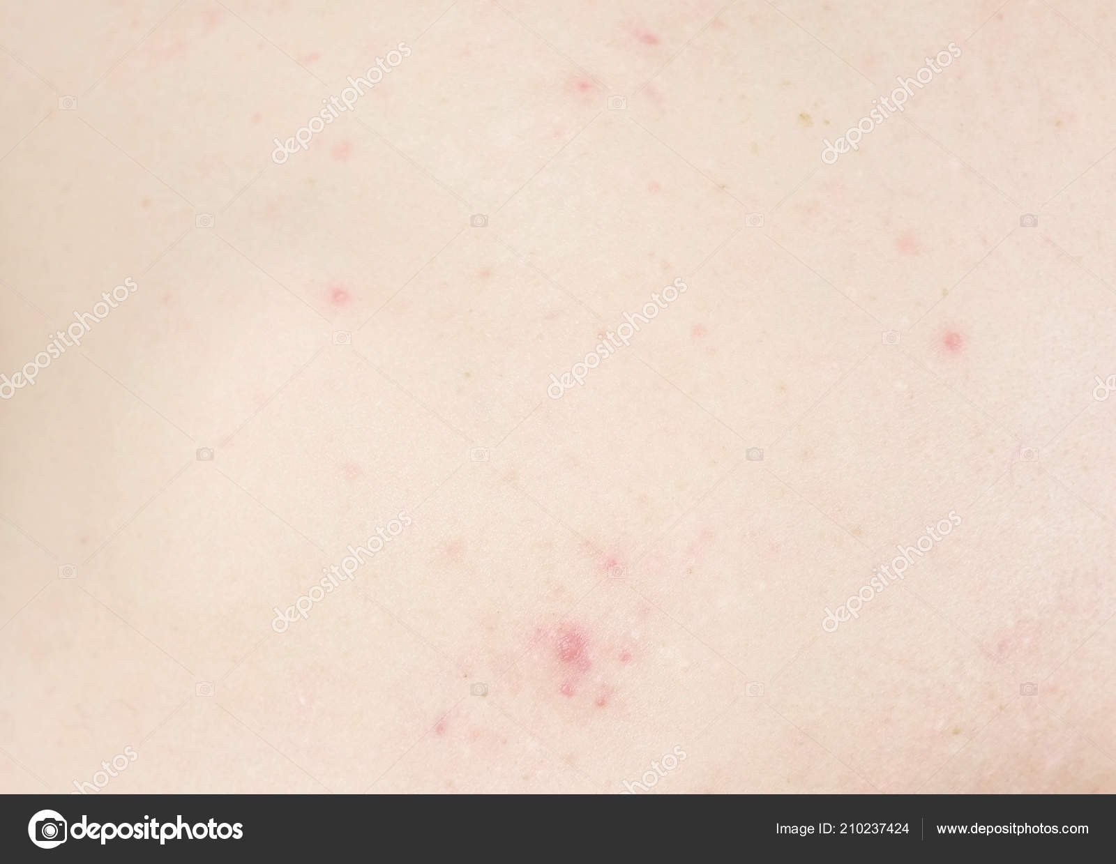 White and red pimples and acne on the mans back. — Stock Photo ...