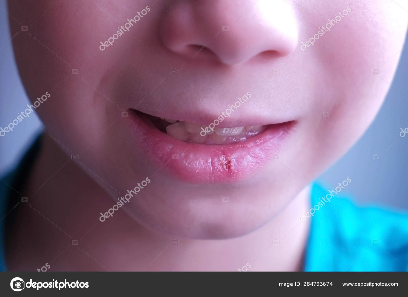 Kid Chapped Lips
