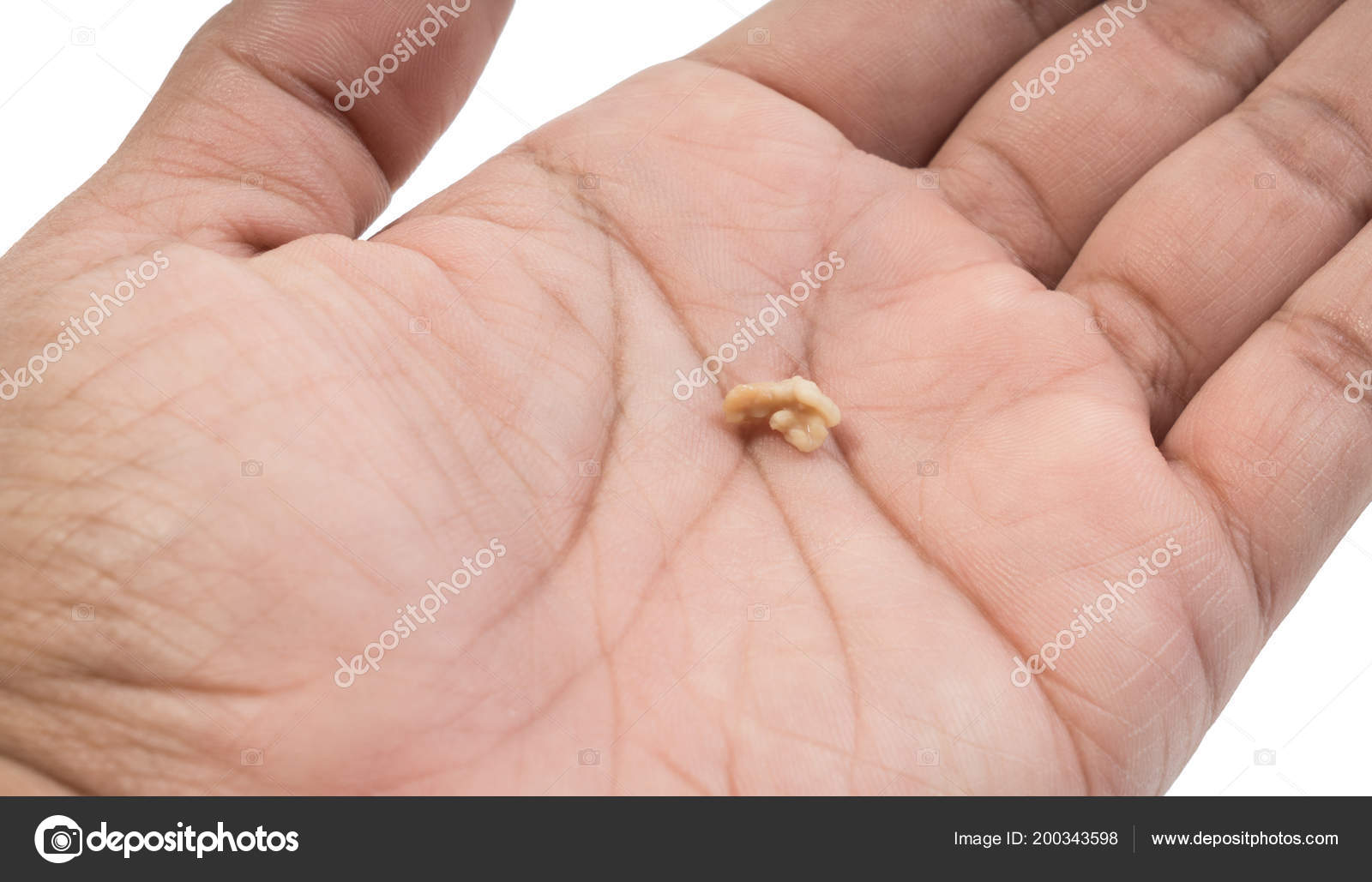 Tonsil Stone Tonsillolith Palm Isolated White Background Tonsil Stones ...