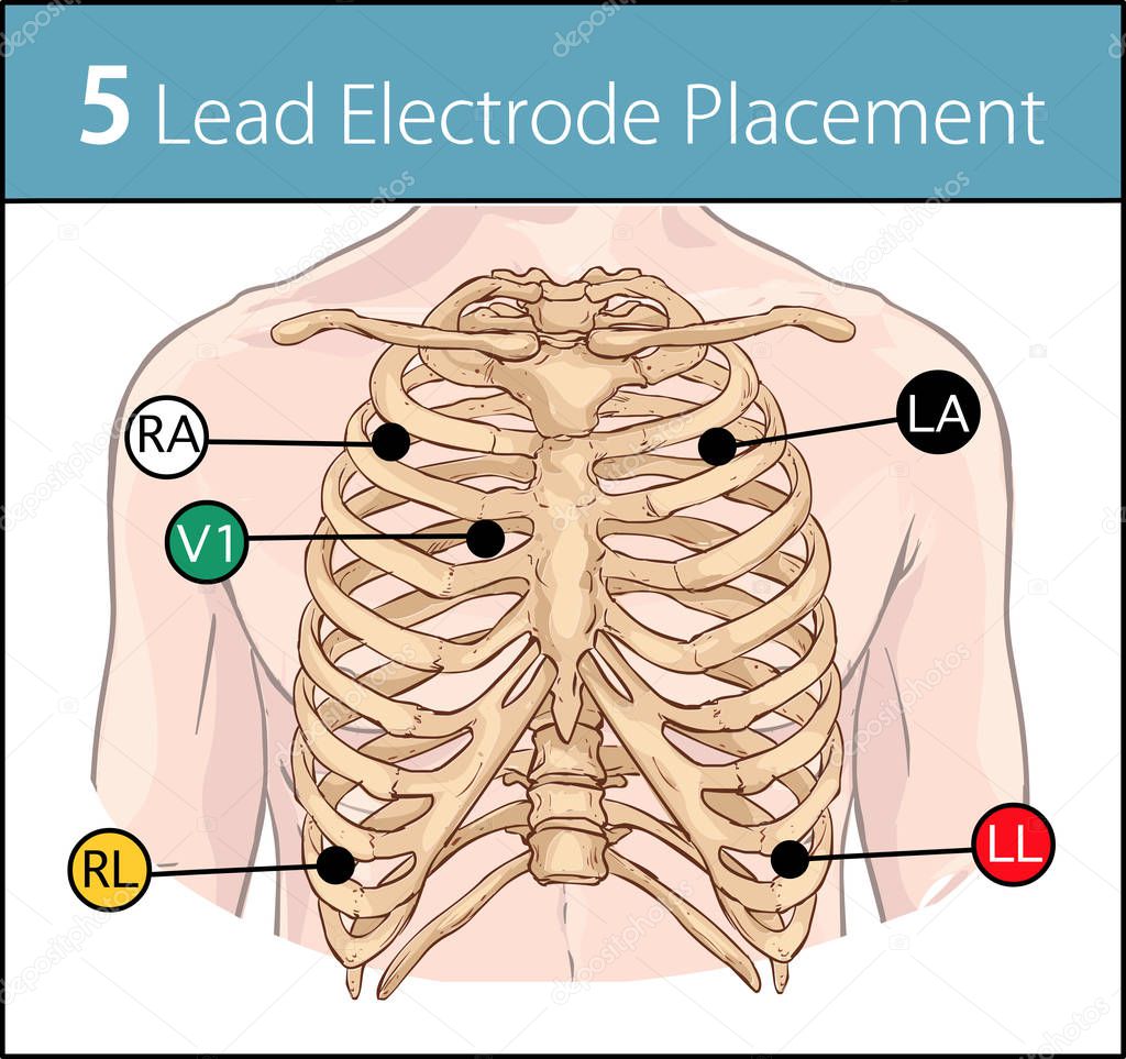 Ilustración vectorial de una colocación de electrodo de 5 derivaciones 2025