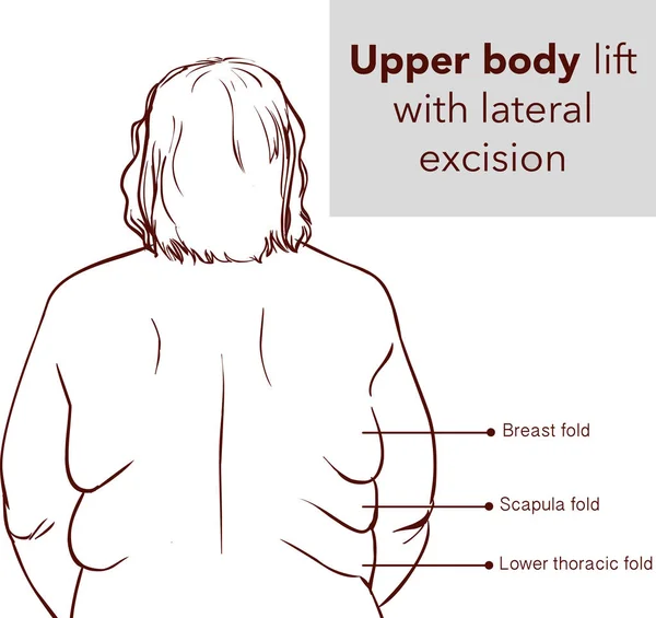 Excision Vector Art Stock Images | Depositphotos