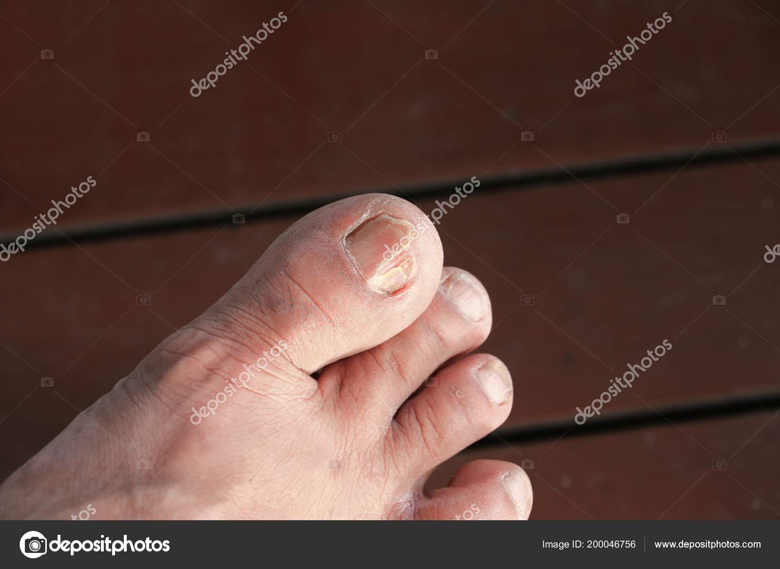 Broken Toenail