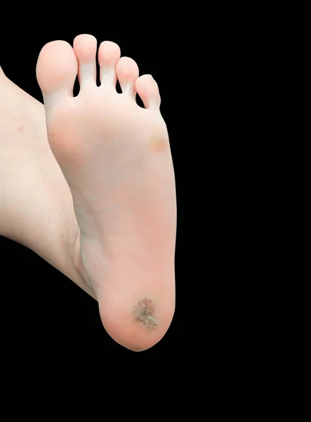 1,598 Foot corn Stock Photos | Free & Royalty-free Foot corn Images ...