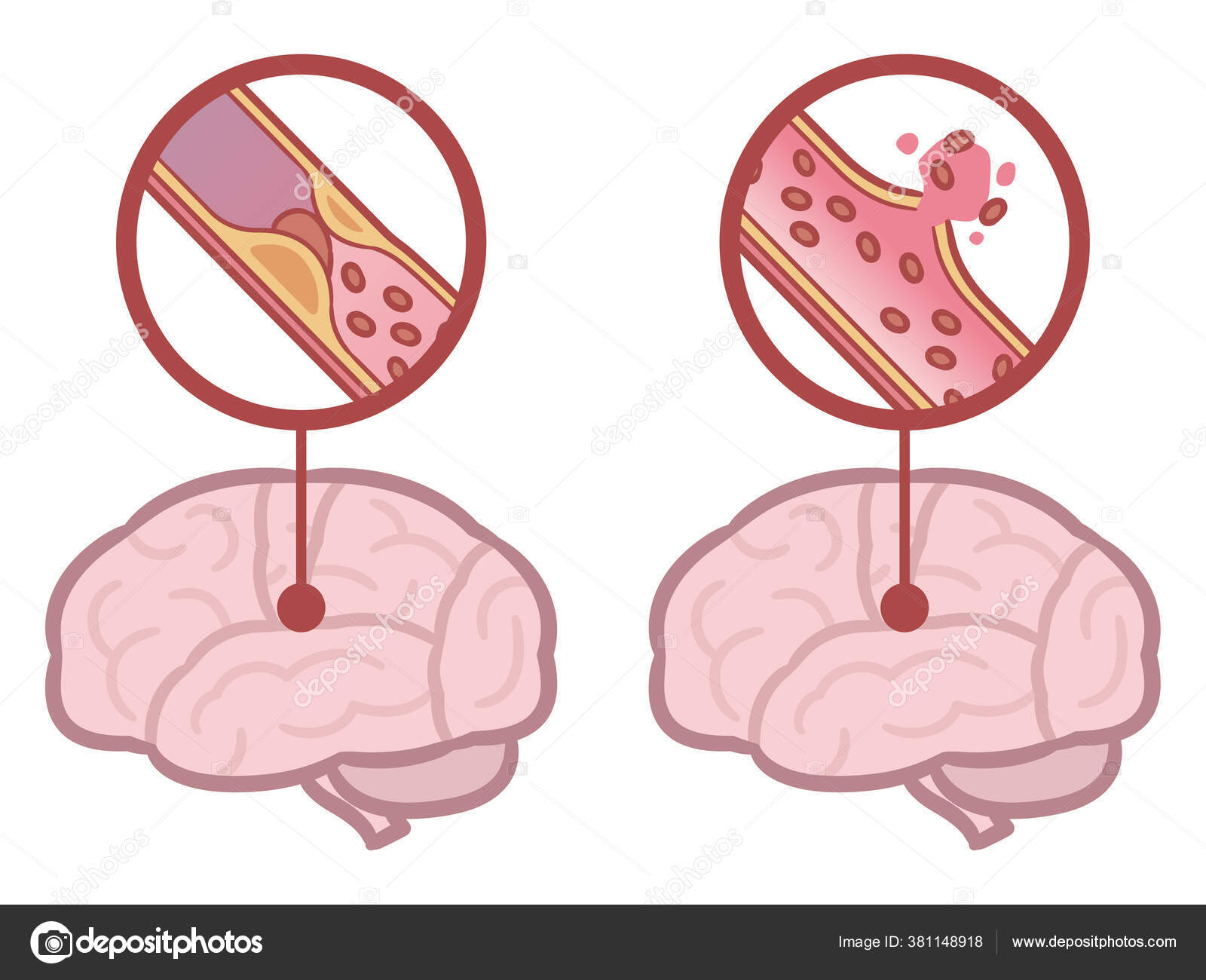 Acv Cerebral Isquémico Hemorrágico Vector de stock por ©ankomando 381148918