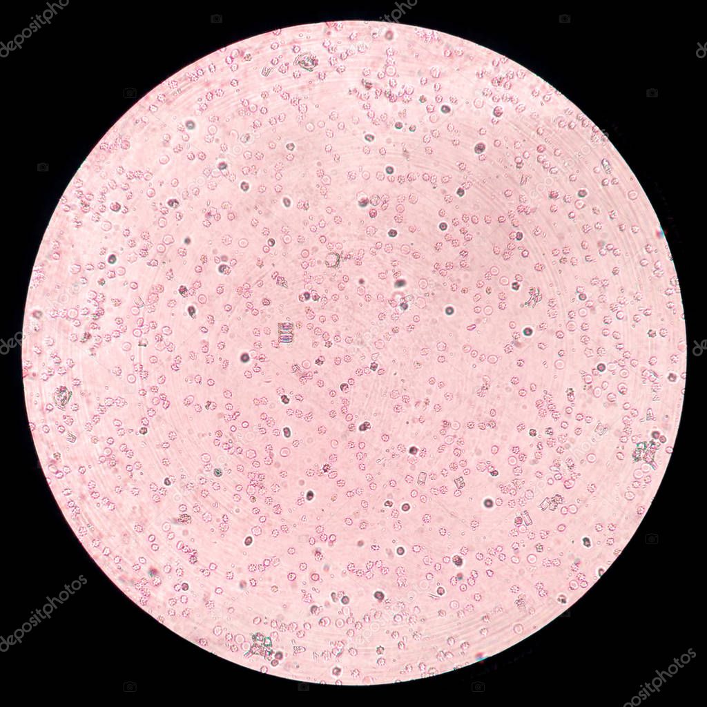 imagen del microscopio de la sangre durante la prueba de compatibilidad ...