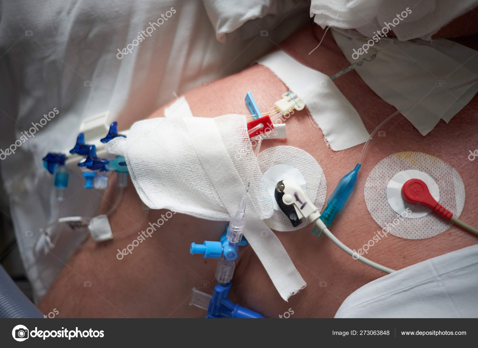 Cateter venoso central instalado em jugulares vena — Fotografia de ...