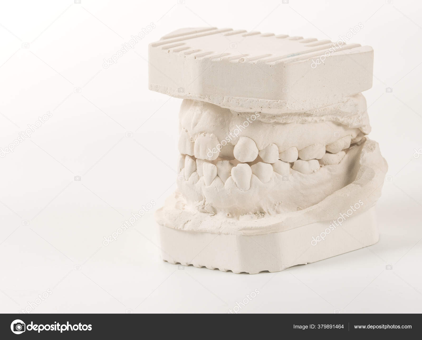 Dental Casting Gypsum Model Human Jaws Crooked Teeth Distal Bite ...