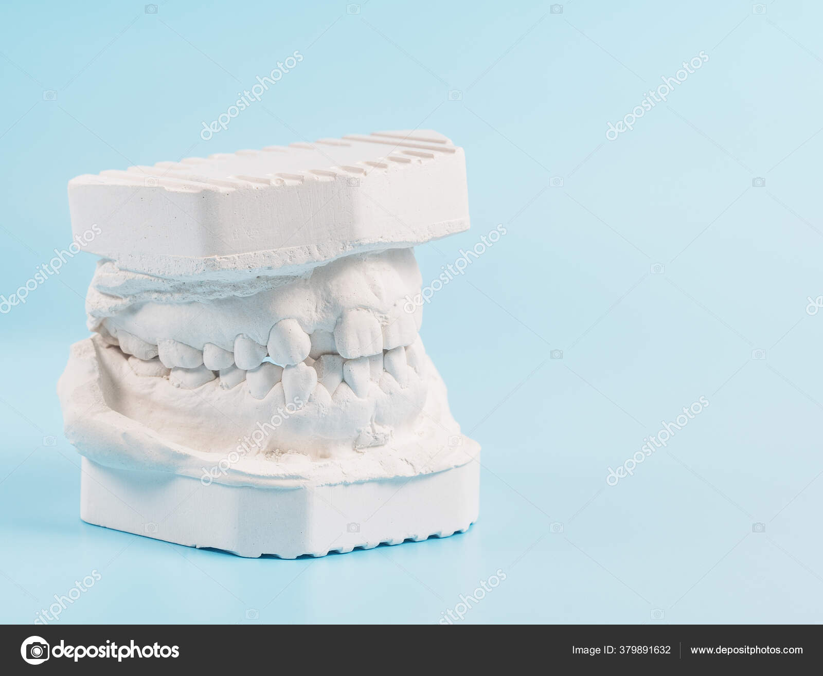 Dental Casting Gypsum Model Human Jaws Crooked Teeth Distal Bite ⬇ ...
