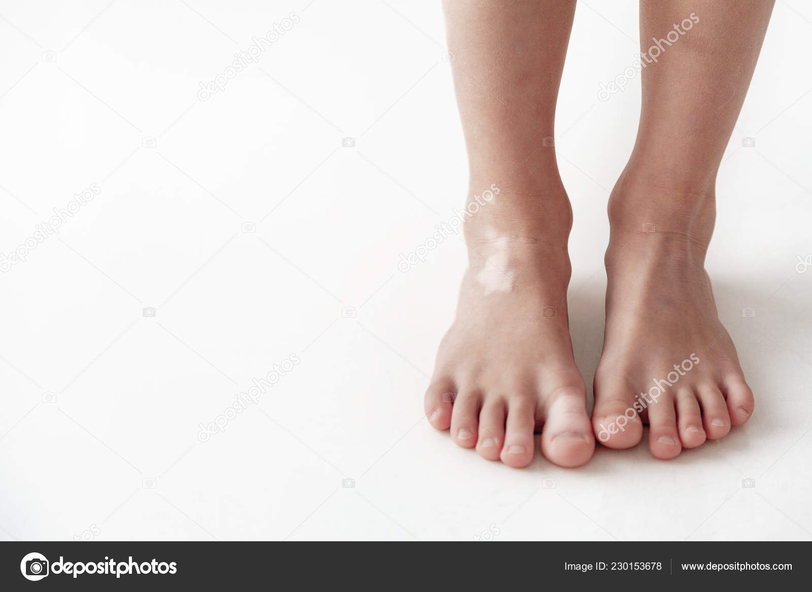 Pictures: age spots on legs | Feet White Background Pigmentation Skin ...