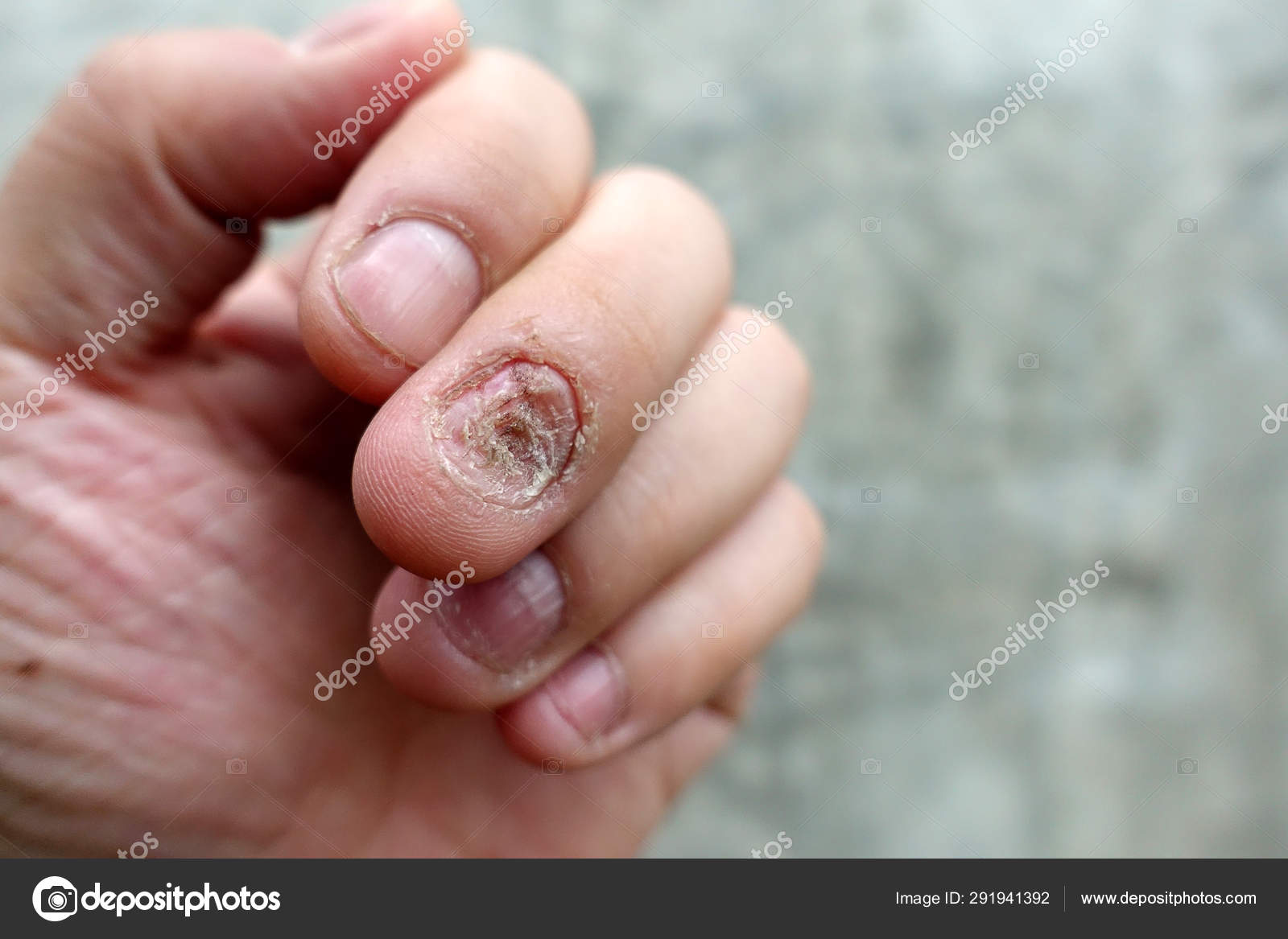 Finger Infection