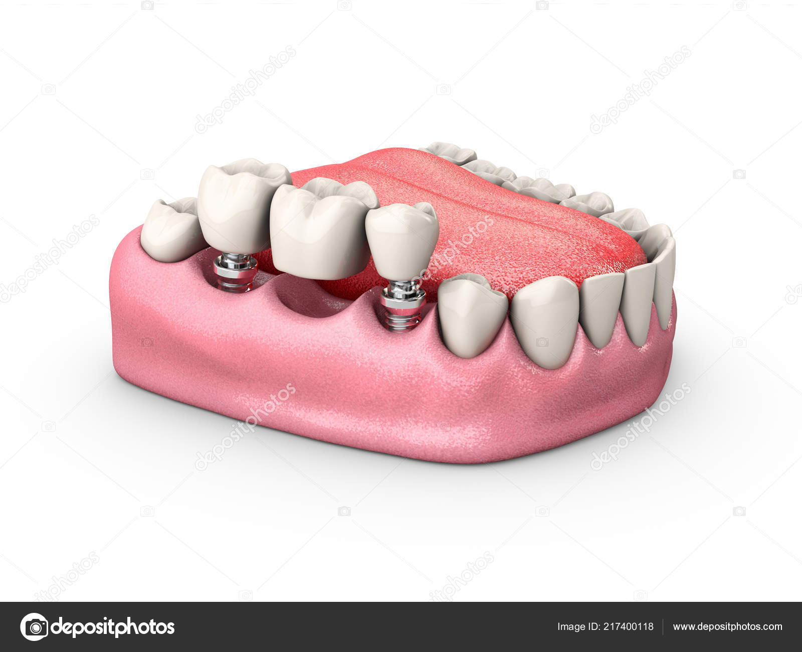 Fixed Partial Dentures