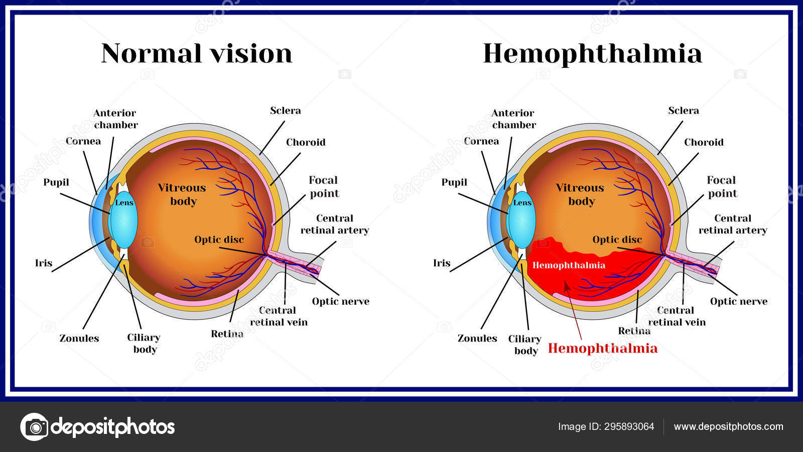 Hemophthalmia Stock Vector Image by ©mrs.bazilio.gmail.com #295893064