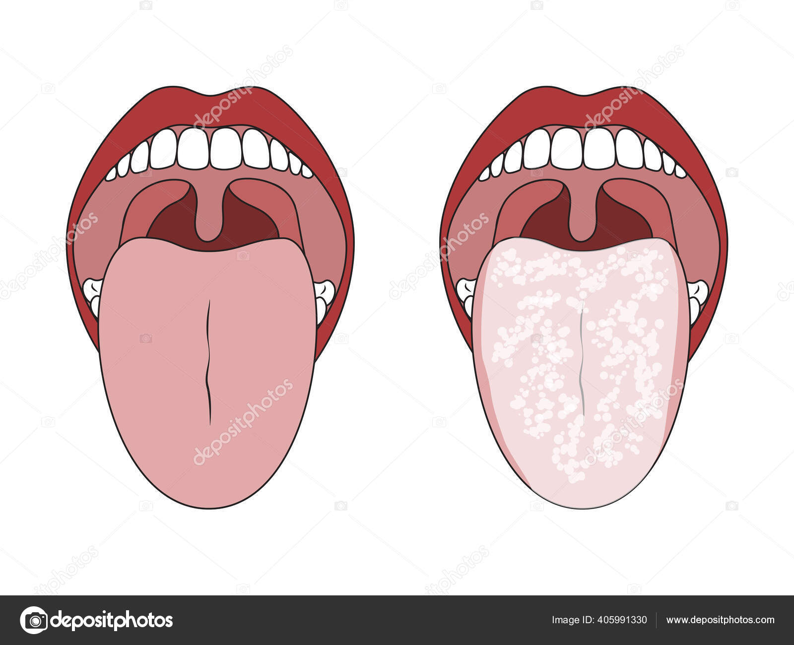 Puhdas terve kieli ja valkoinen päällystetty kieli., aineistopankin ...
