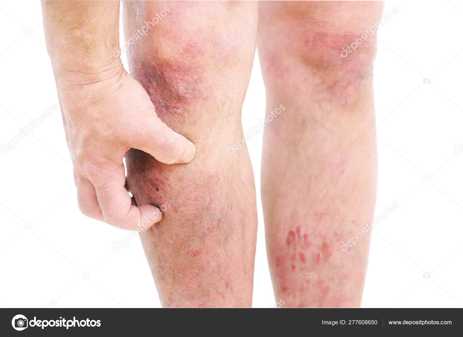 Atopische Dermatitis Ook Bekend Als Atopisch Eczeem Een Type ...