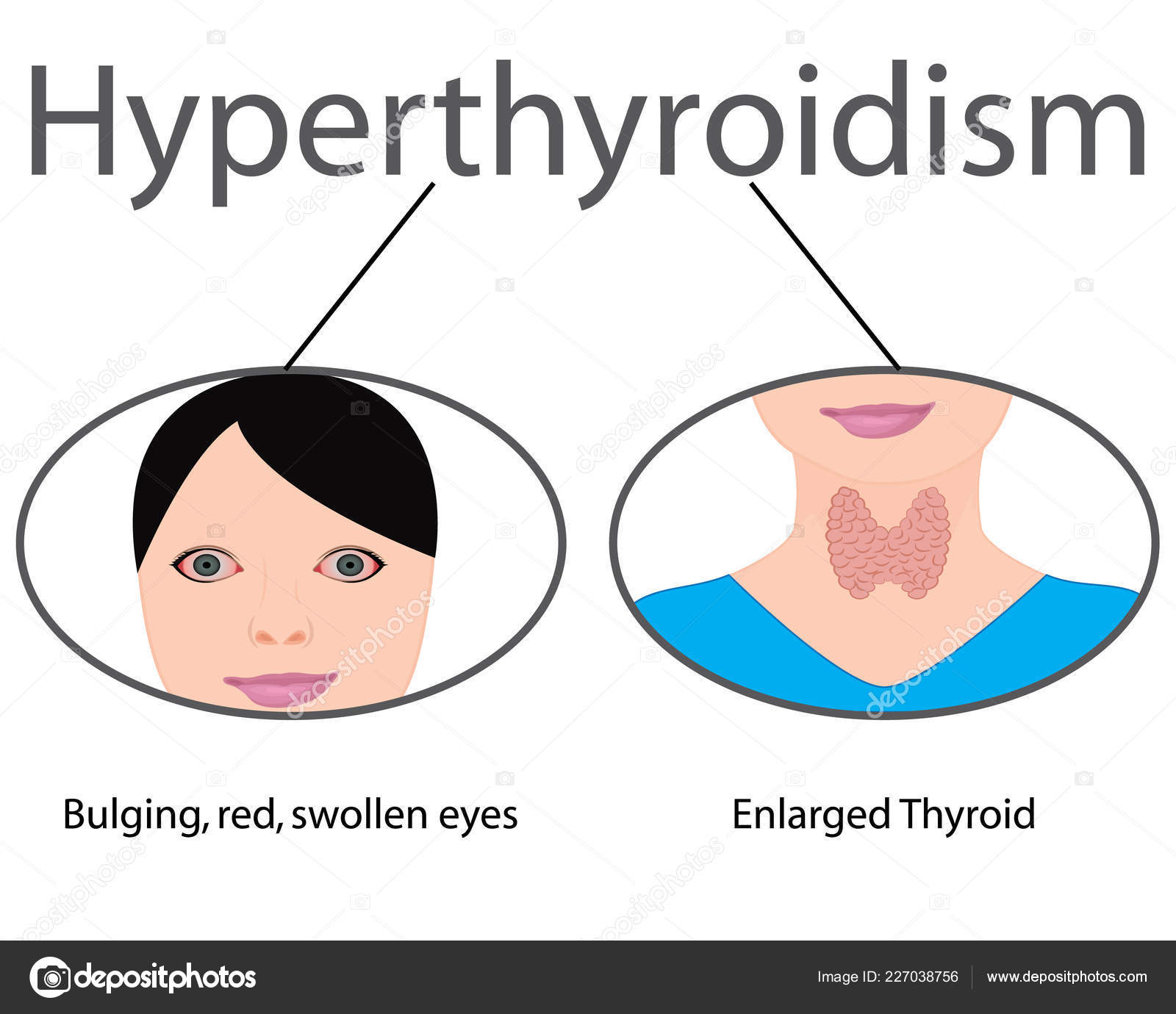 Hyperthyroidism. Enlarged Thyroid. Endocrine disfunction vector ...