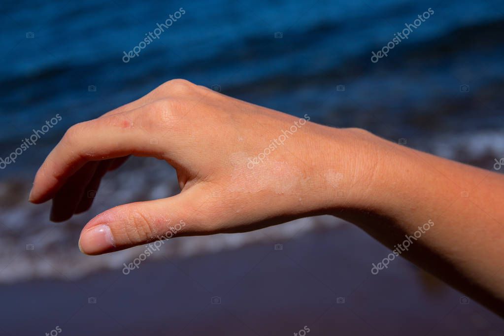 Piel quemada por el sol con cáscara sobre fondo marino tropical. Sol quemó la mano femenina ...