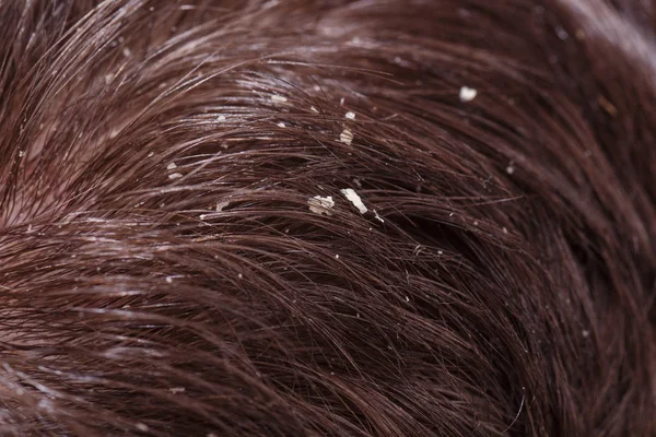 Dandruff on male dark hair Stock Photo by ©1odinmig.gmail.com 192550766