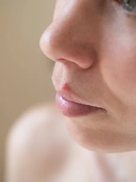 Cold sores woman Stock Photos, Royalty Free Cold sores woman Images ...