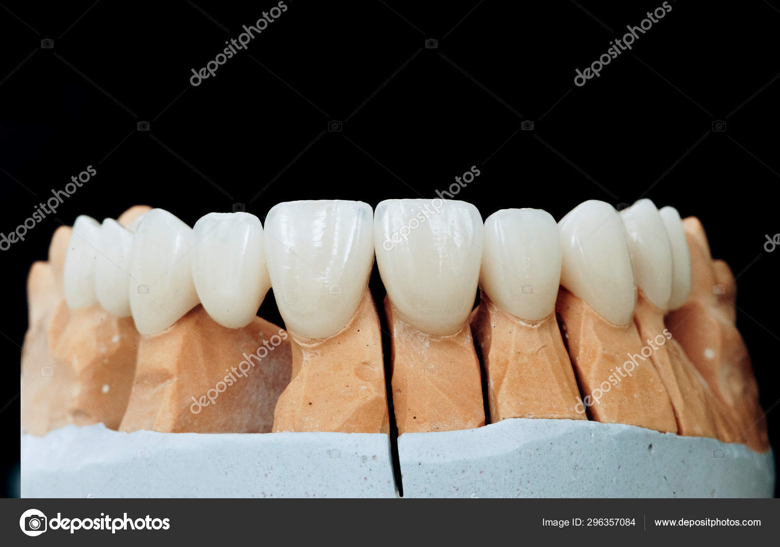 Ceramic teeth with the implant on a plaster model isolated on a black ...
