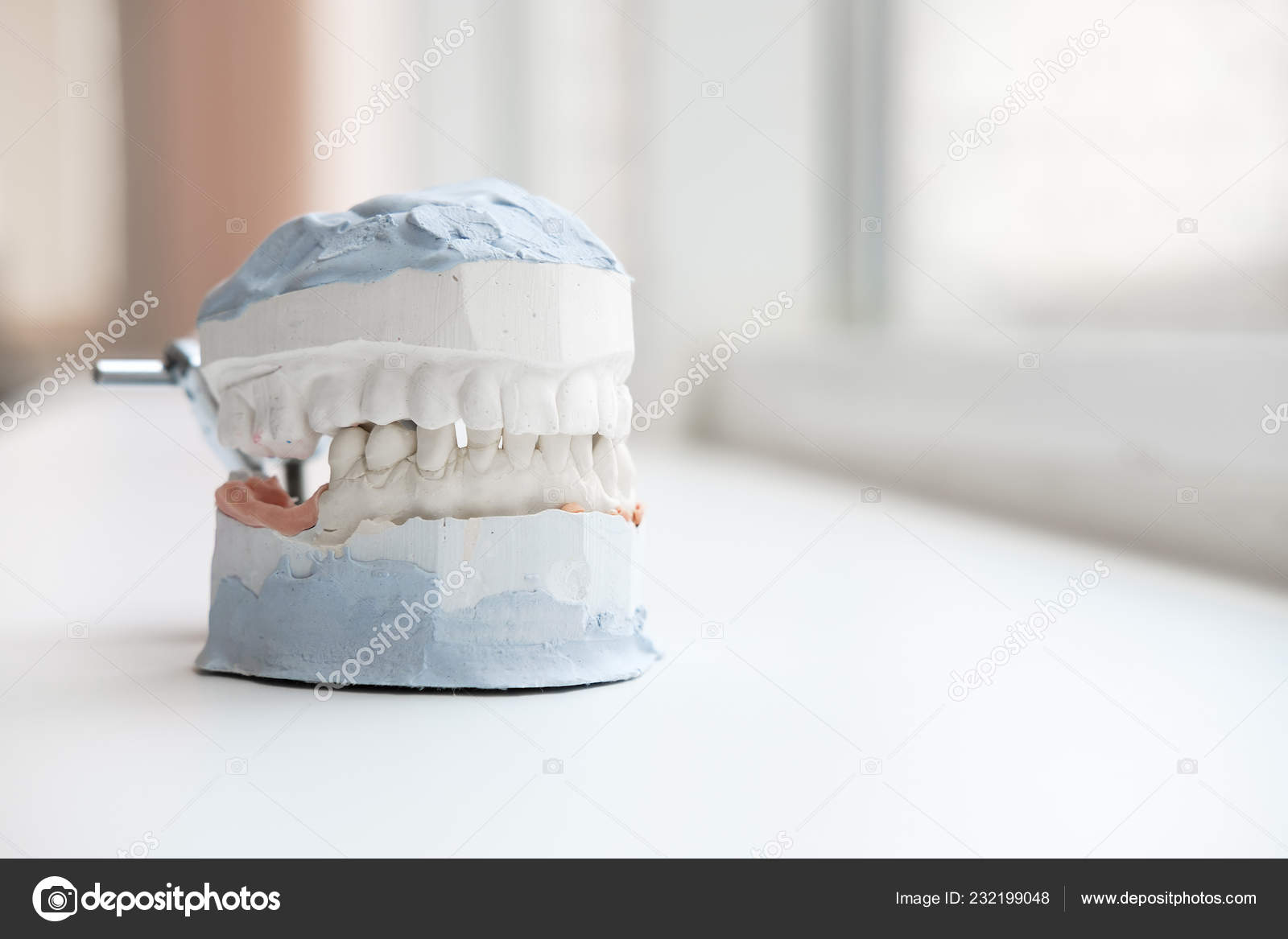 Plaster Cast Jaws Dental Casting Gypsum Model Human Jaws Prosthetic ...