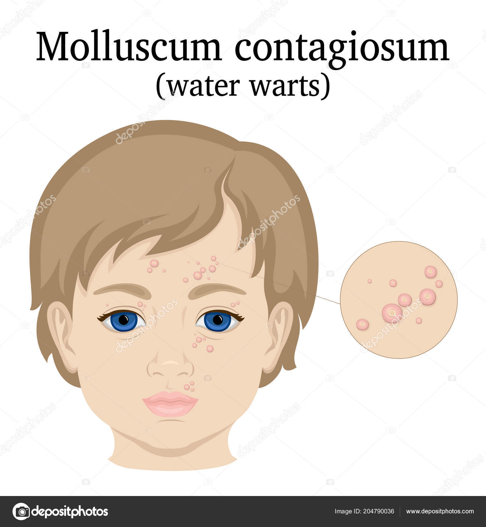 Molluskin Bambini DIMITRI DERMATOLOGY Updated February 2025 24